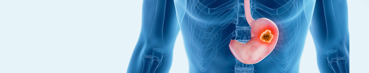 Maagkanker: maagverwijdering voorkomen door surveillance | Radboud ...